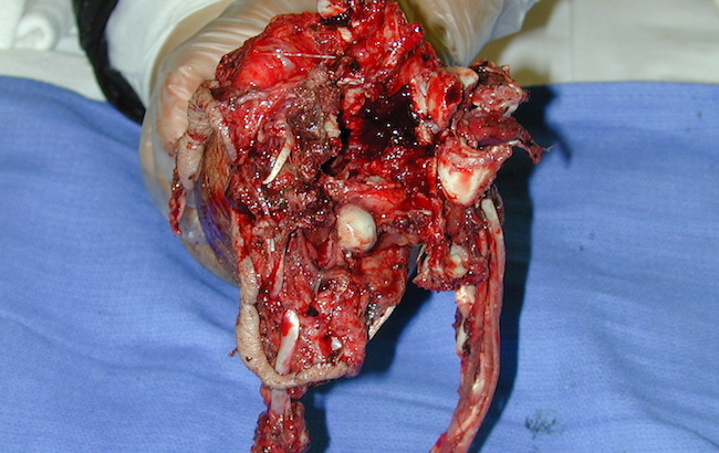 AMPUTATION, FOREARM | Hand Surgery Resource